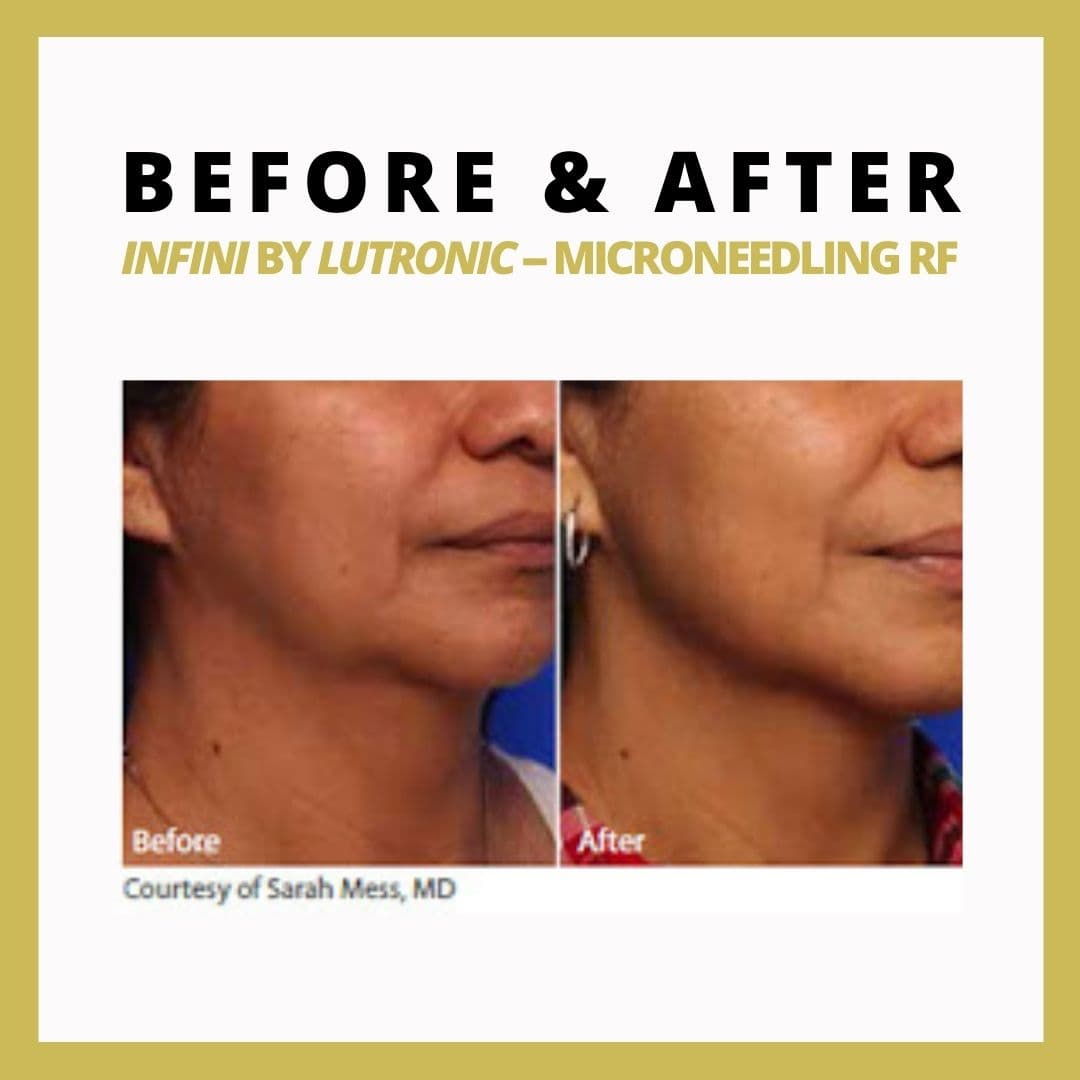 Micro Needling Treatments For Acne Scarring in Birmingham