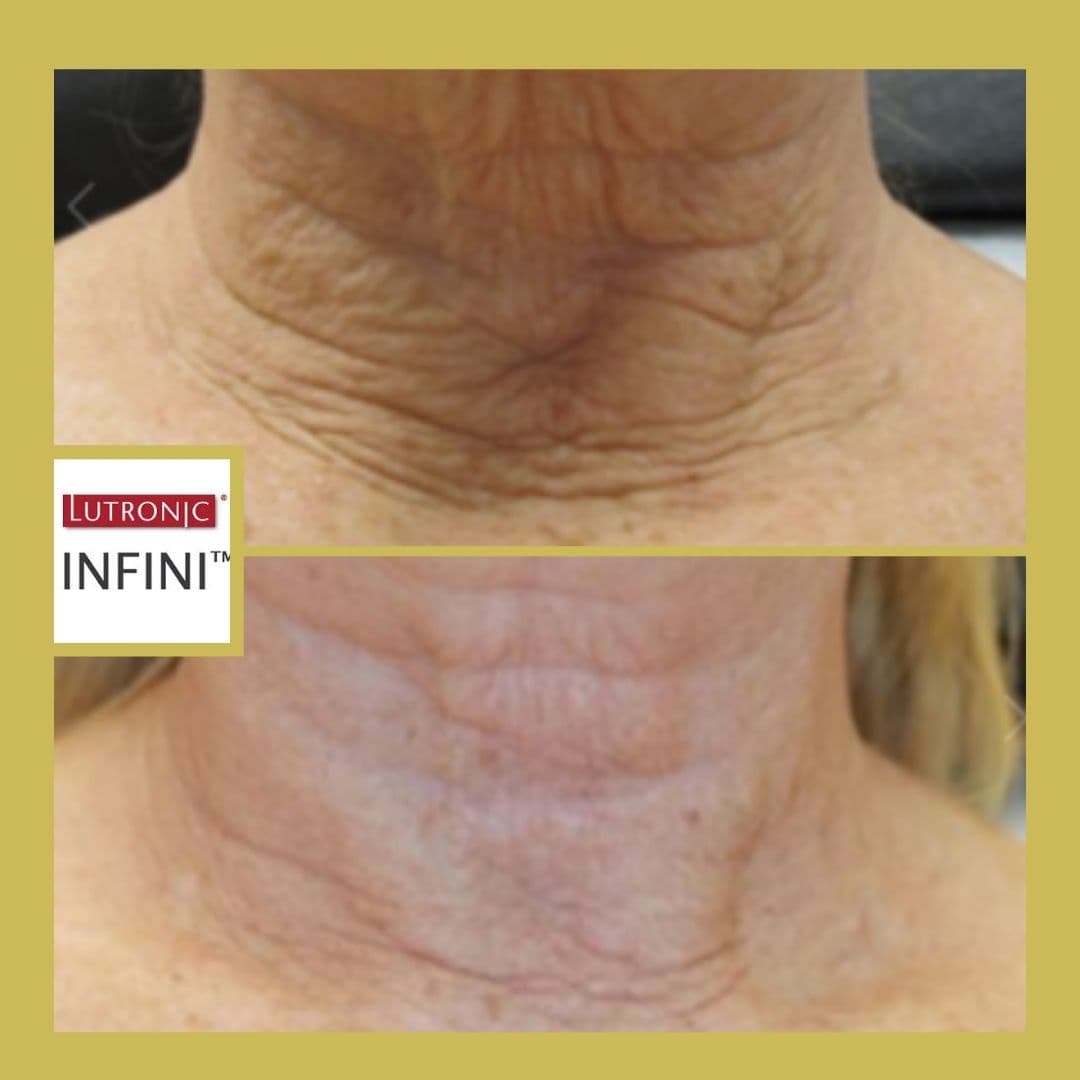 Micro Needling Treatments For Acne Scarring in Birmingham